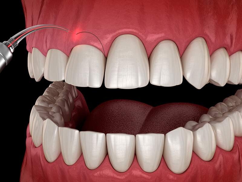 Cirurgia odontológica em Santa Cruz do Sul – RS – Dettenborn